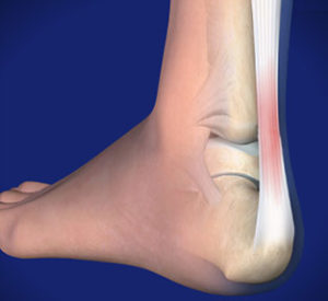 Achilles Tendon Lengthening